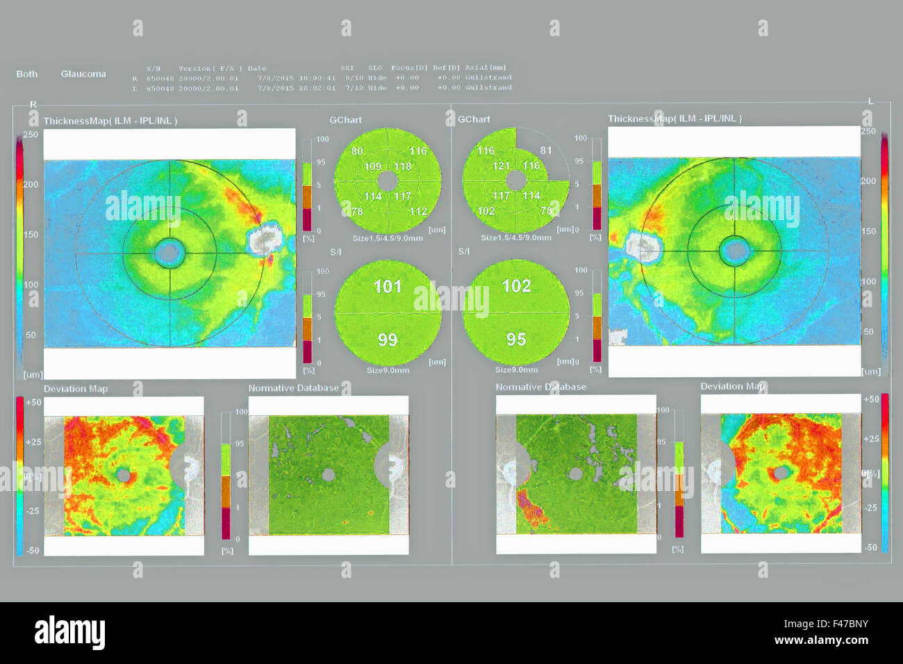 OPTICAL COHERENCE TOMOGRAPHY Stock Photo - Alamy