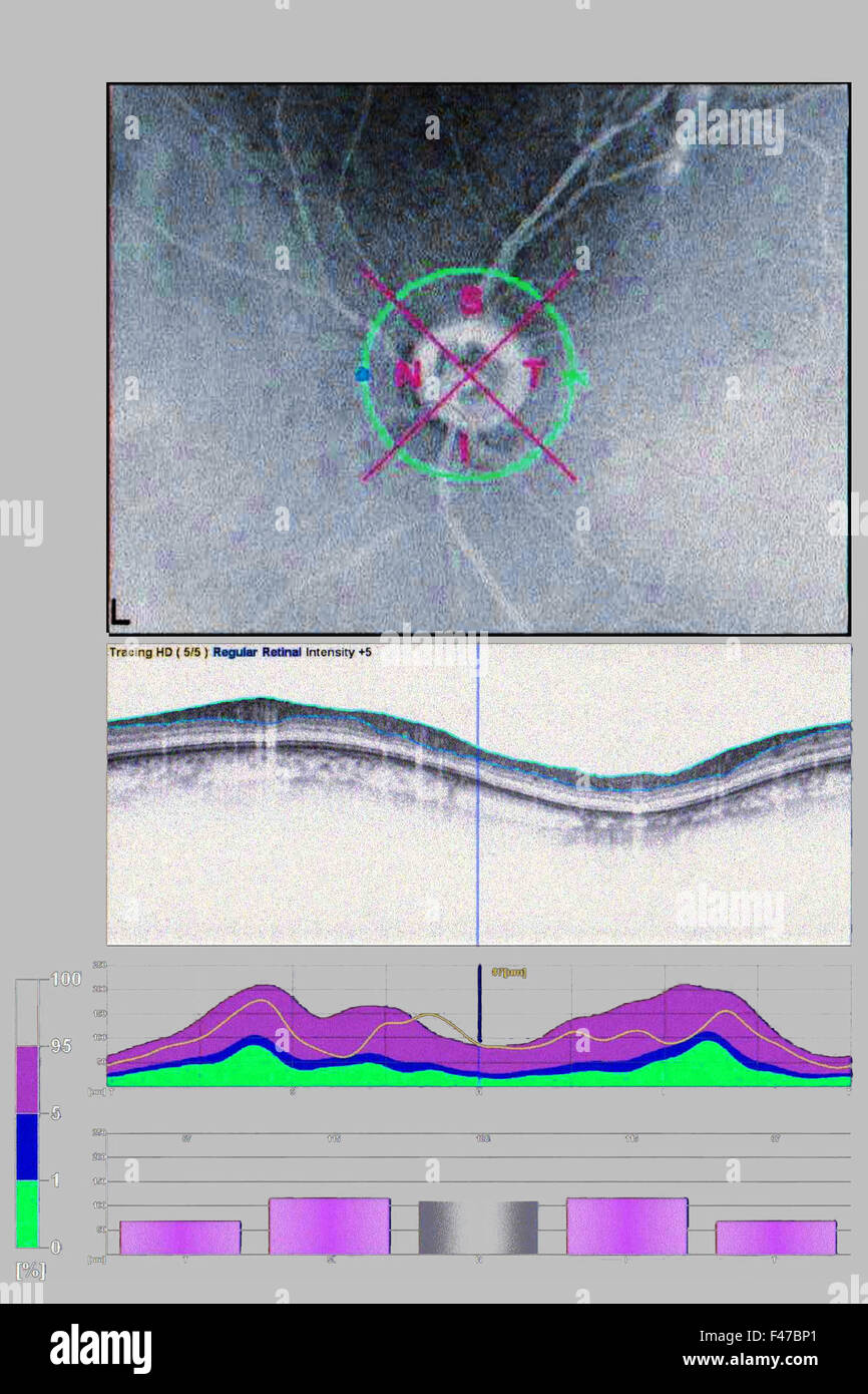 OPTICAL COHERENCE TOMOGRAPHY Stock Photo - Alamy