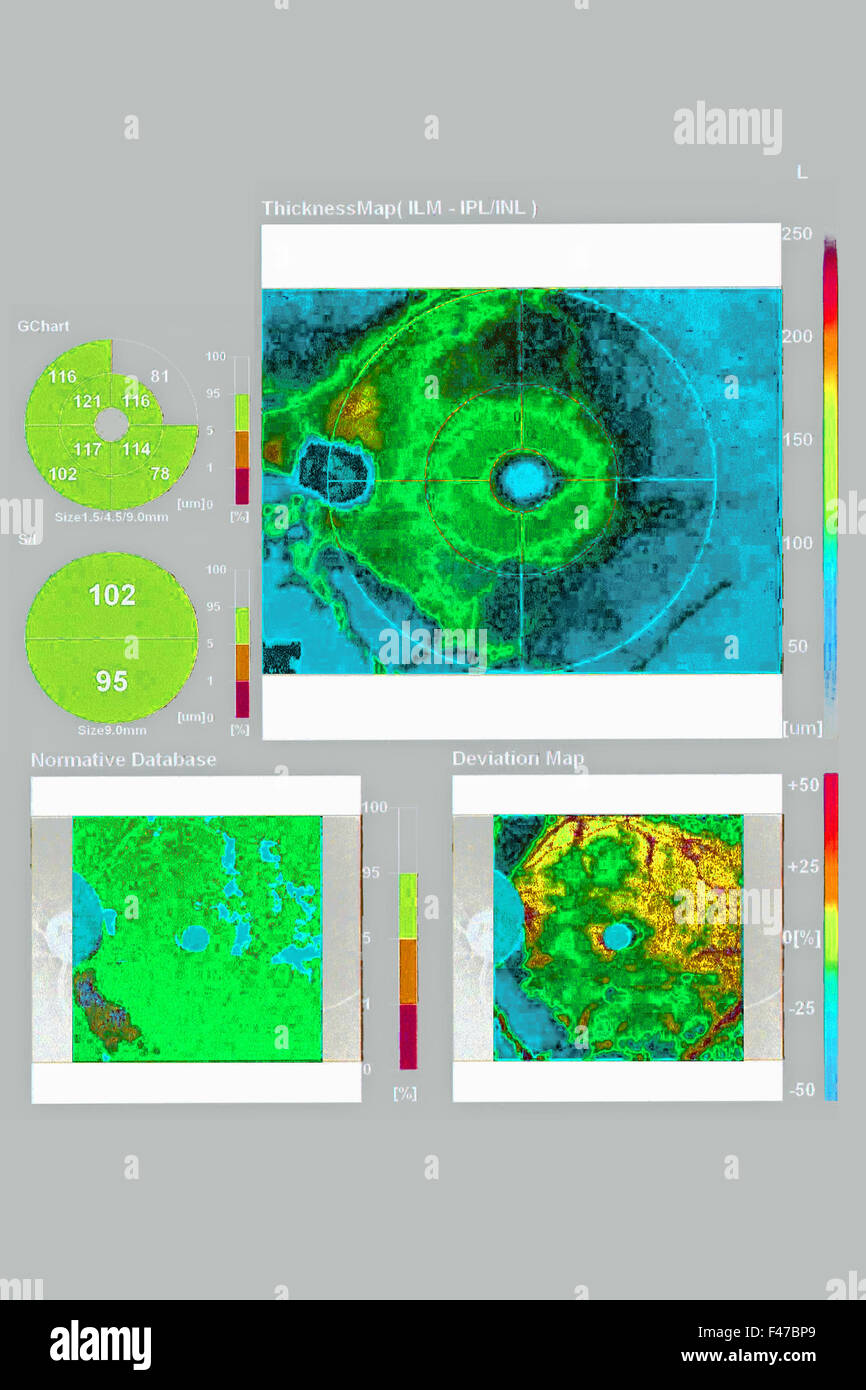 OPTICAL COHERENCE TOMOGRAPHY Stock Photo - Alamy