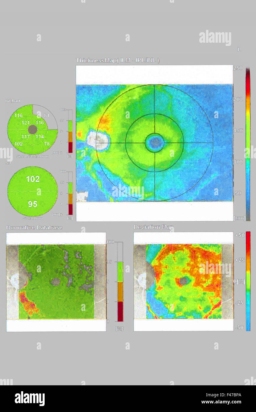 OPTICAL COHERENCE TOMOGRAPHY Stock Photo - Alamy