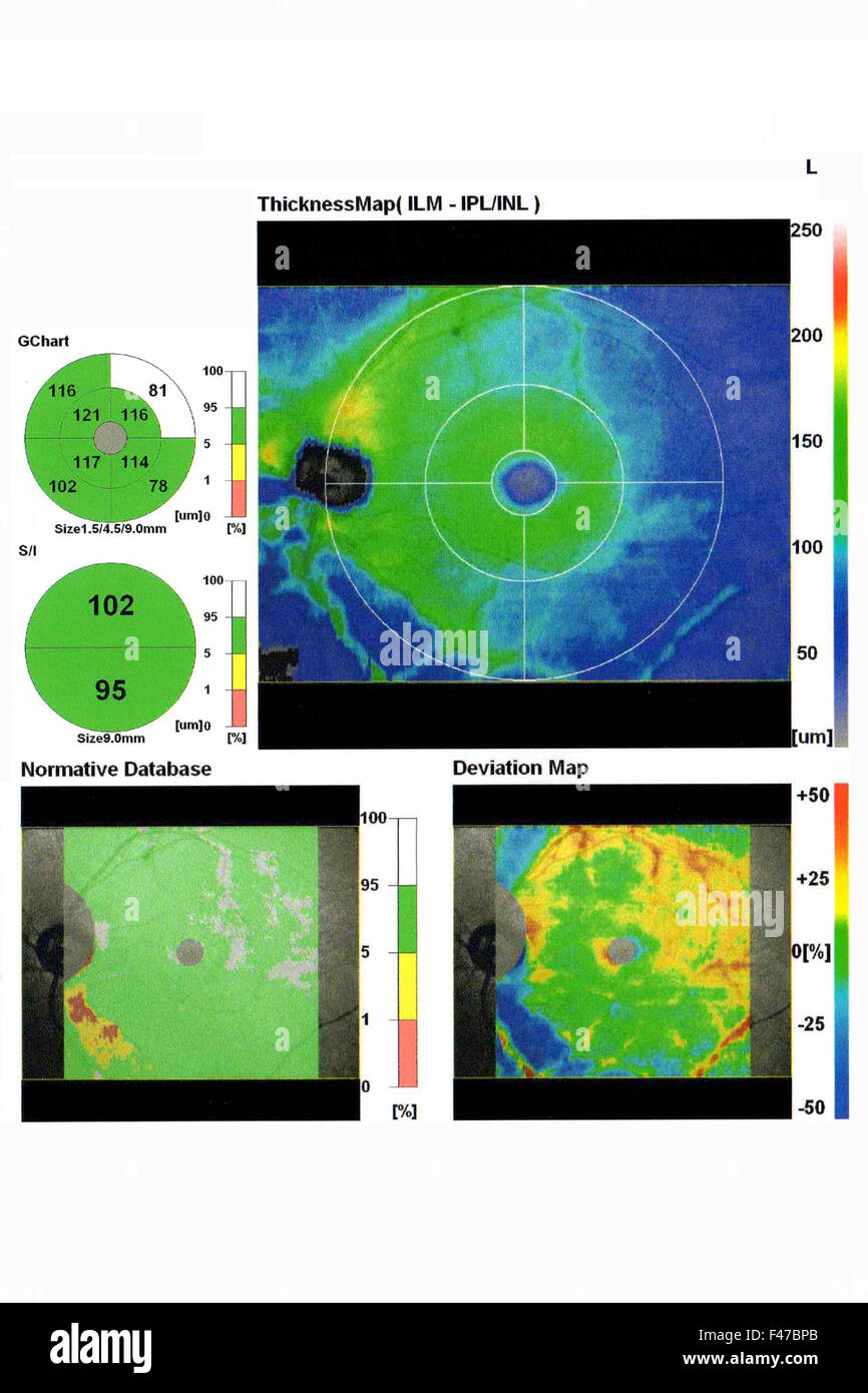 OPTICAL COHERENCE TOMOGRAPHY Stock Photo - Alamy