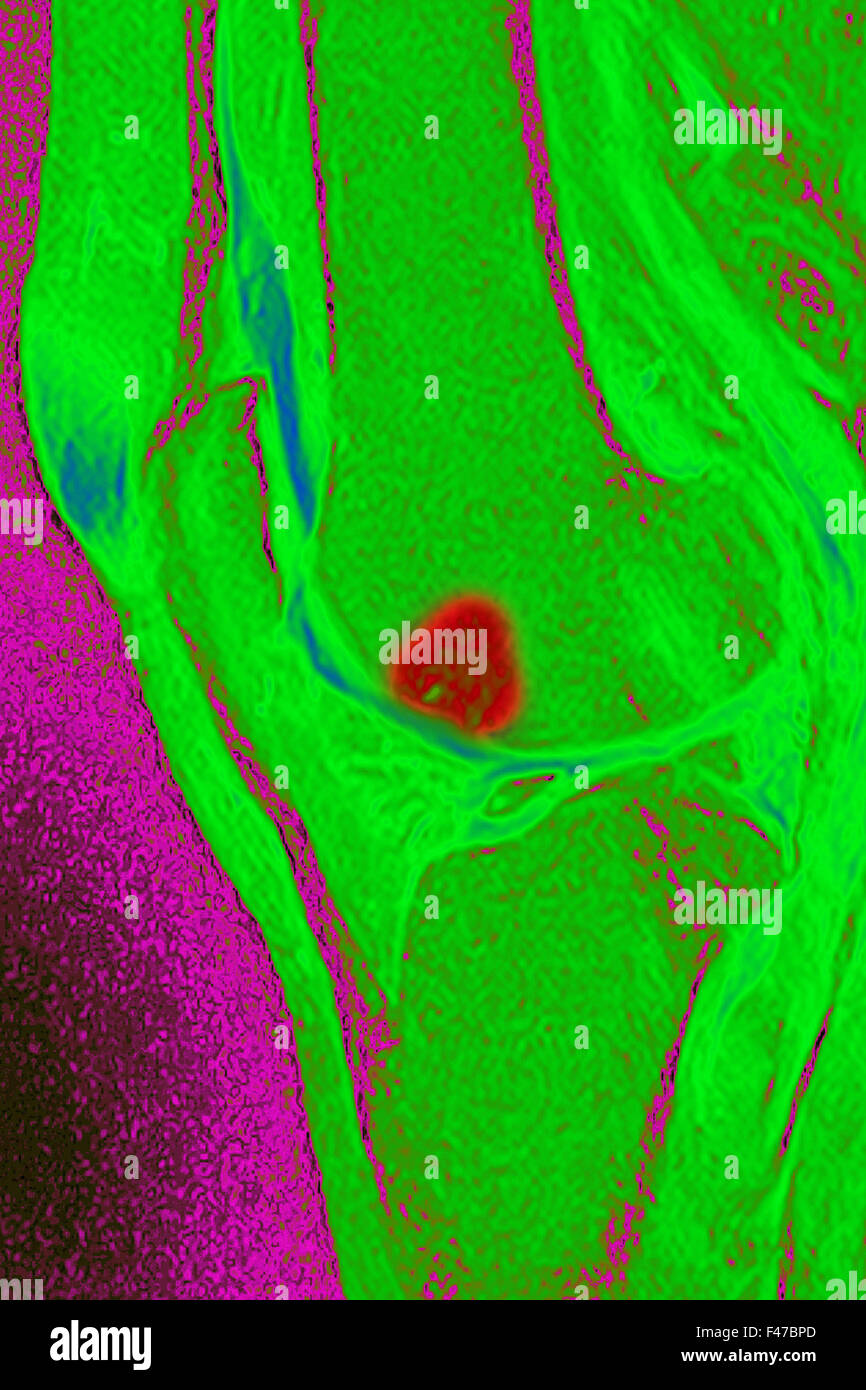 OSSEOUS EDEMA MRI Stock Photo - Alamy
