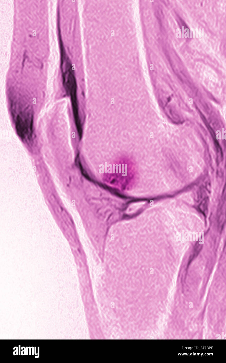 OSSEOUS EDEMA MRI Stock Photo - Alamy