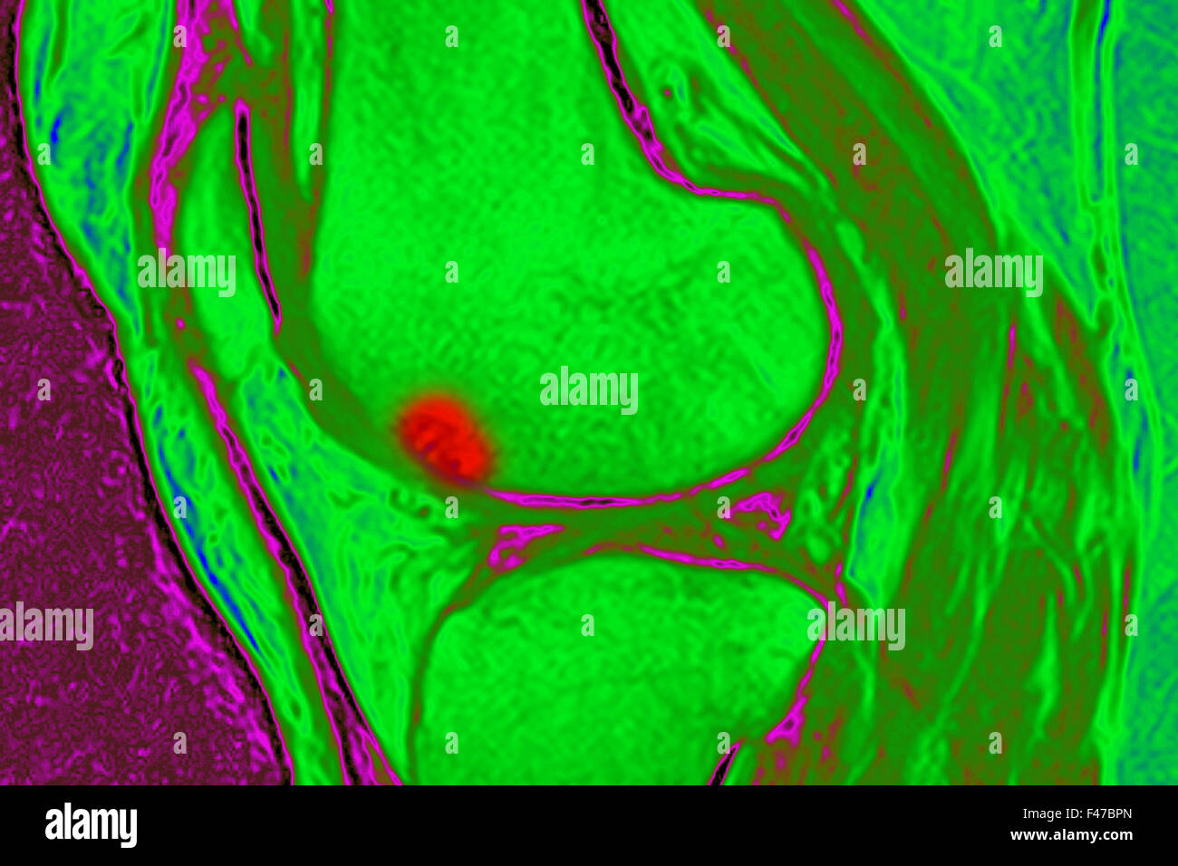 OSSEOUS EDEMA MRI Stock Photo - Alamy