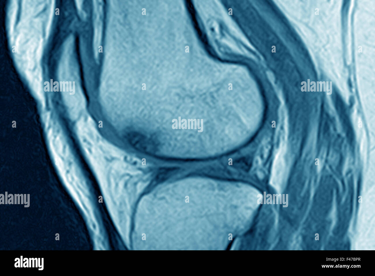 OSSEOUS EDEMA MRI Stock Photo - Alamy