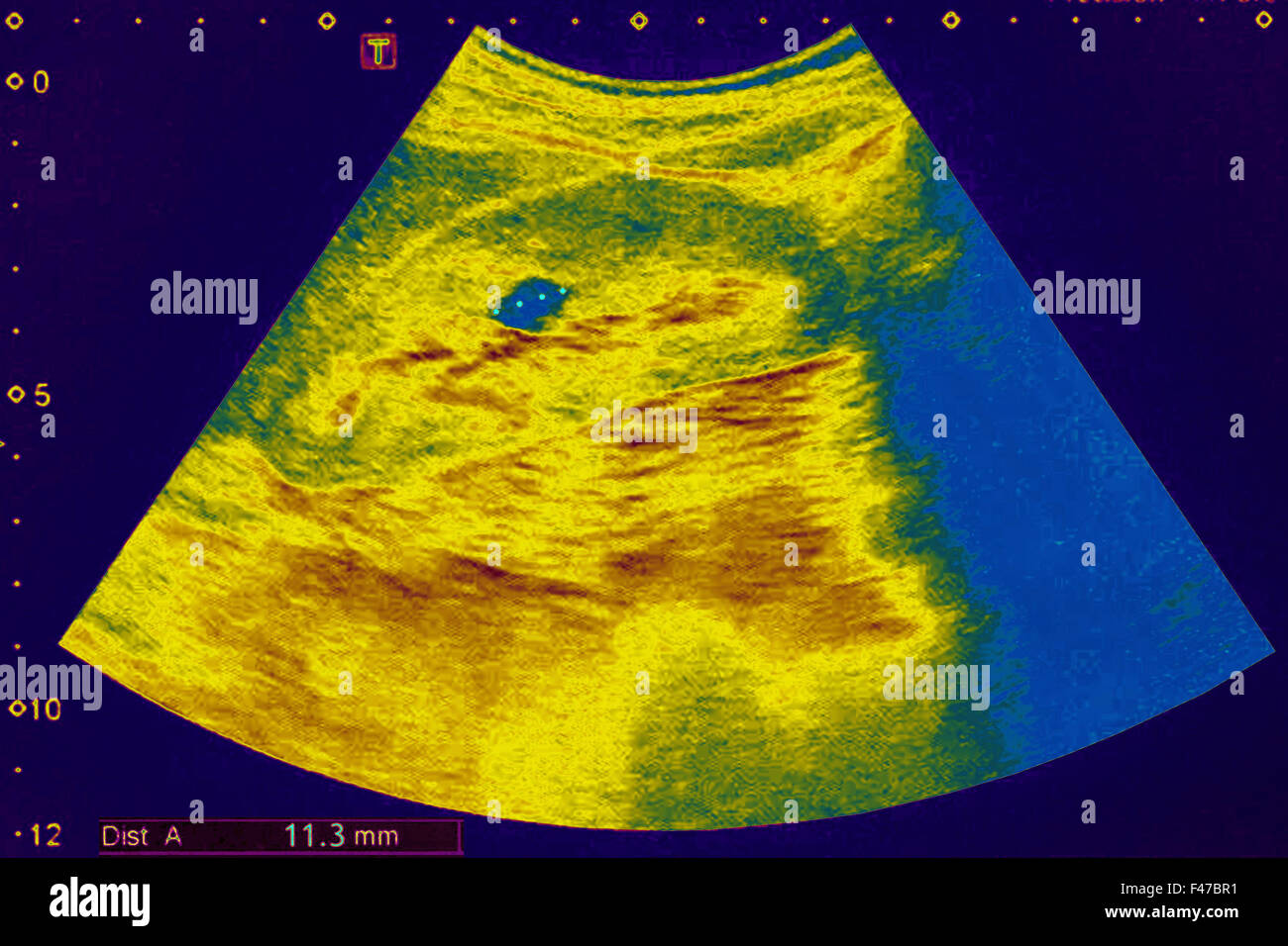 Benign cyst hi-res stock photography and images - Alamy