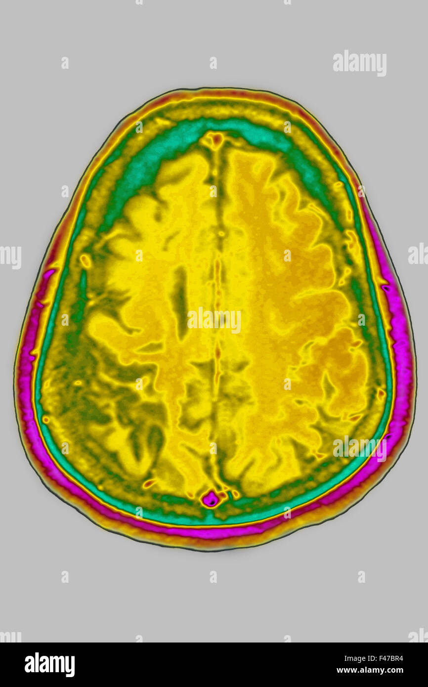 Cerebral atrophy hi-res stock photography and images - Alamy