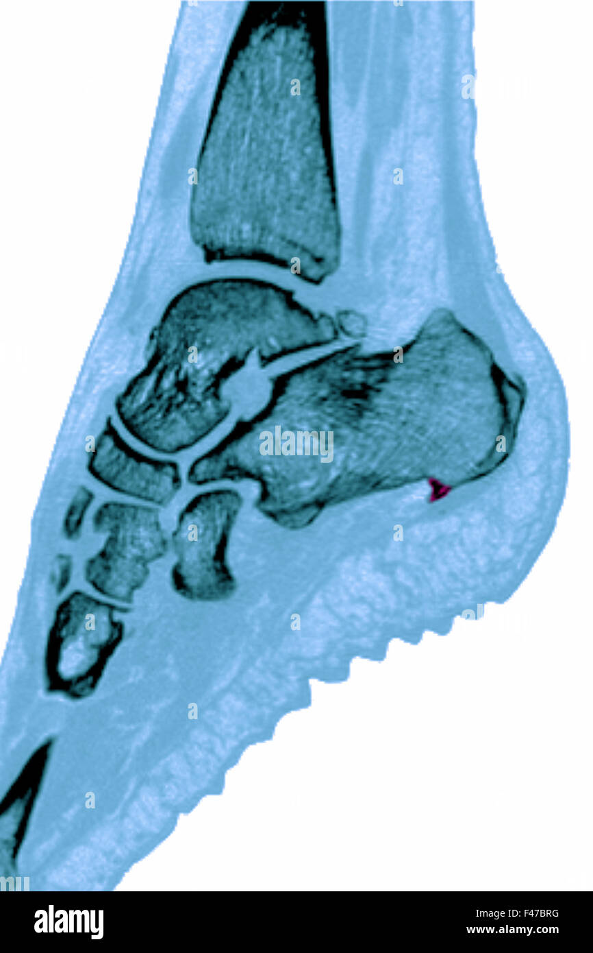 Enthesitis hi-res stock photography and images - Alamy