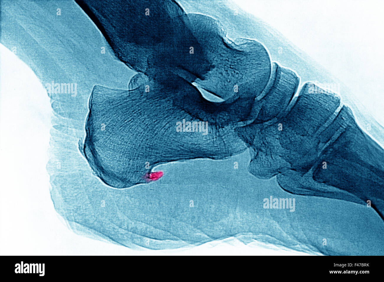 Calcaneum High Resolution Stock Photography and Images - Alamy