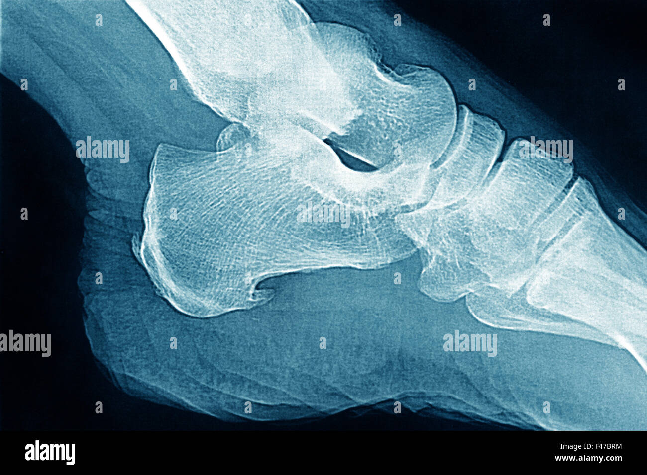 X ray bones of the lower limbs hi-res stock photography and images - Alamy