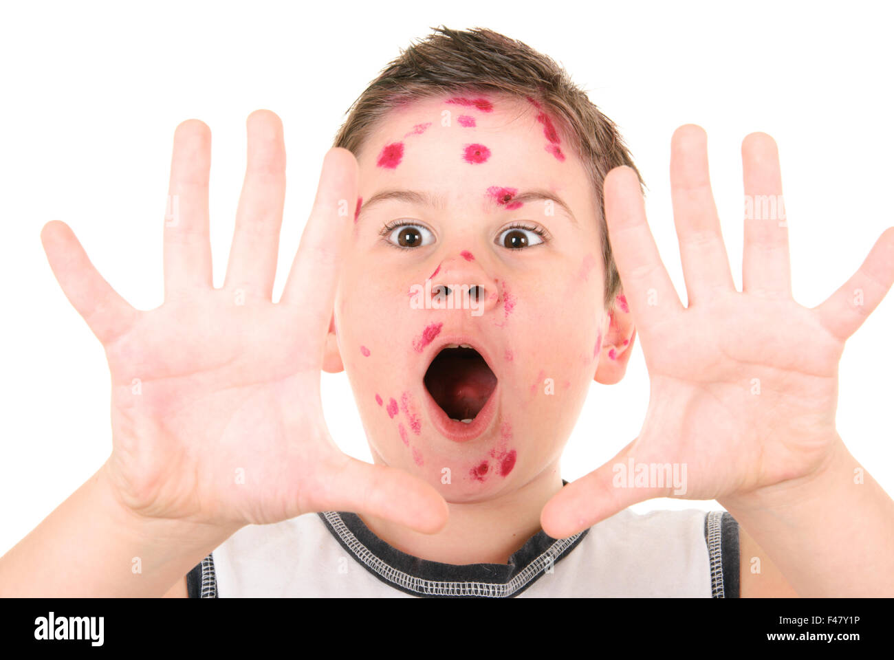 Sick chicken pox boy Stock Photo - Alamy