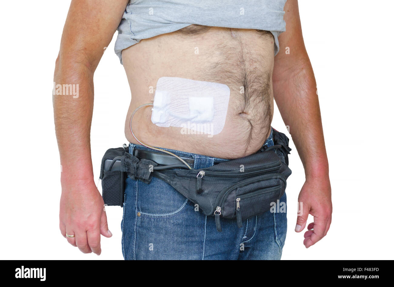 Left ventricular assist devices hi-res stock photography and images - Alamy