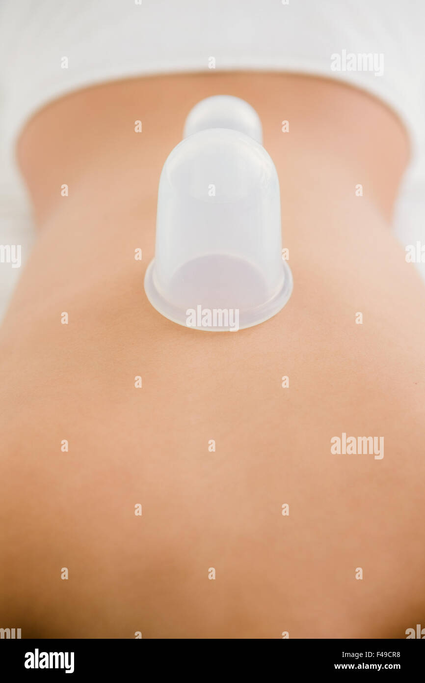Woman with vacuum cups on her back Stock Photo - Alamy