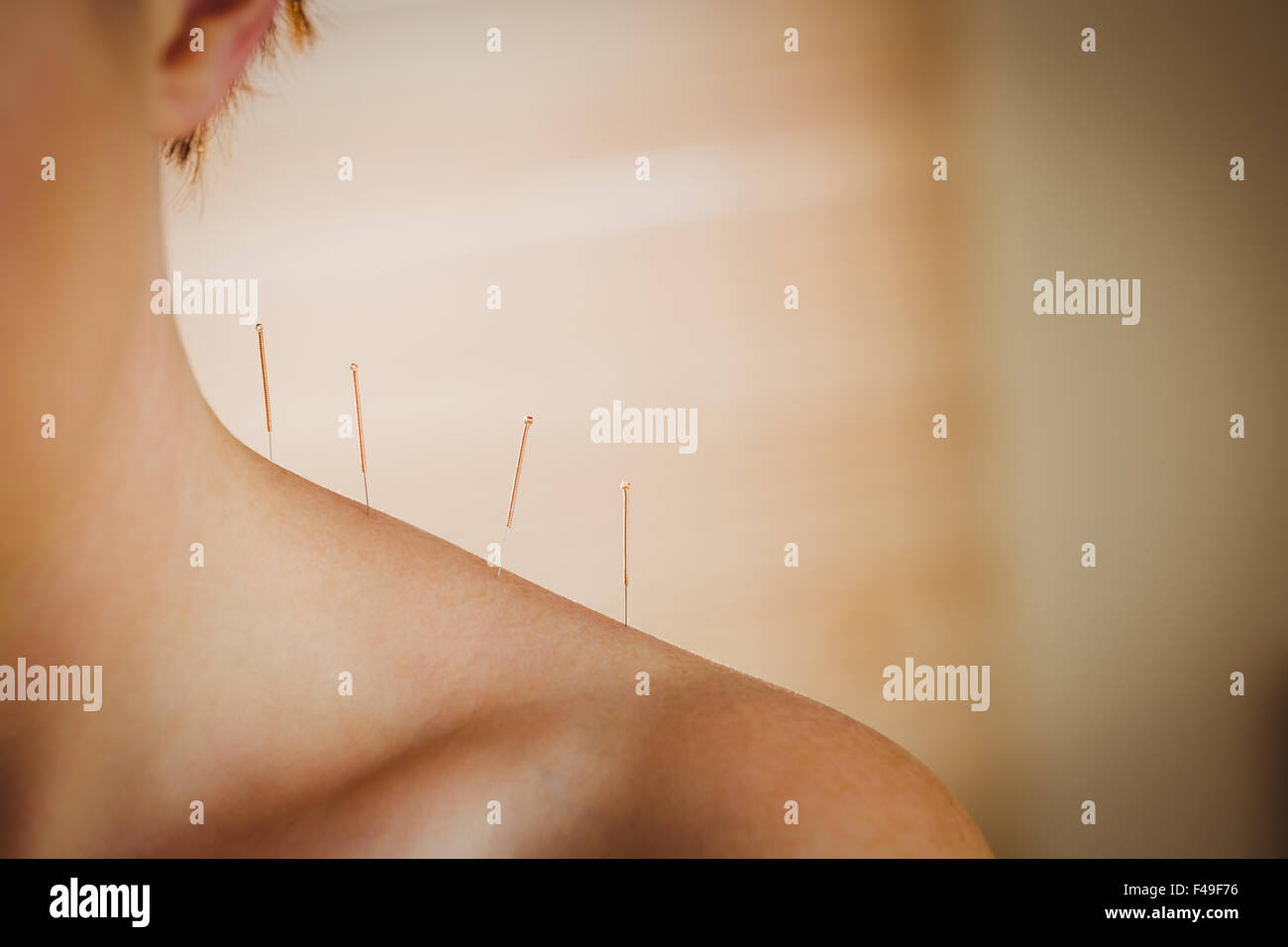 Young woman getting acupuncture treatment Stock Photo - Alamy
