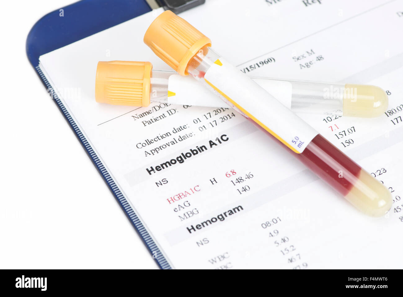 Hematology A1C blood level diabetes report with gold cap blood sample ...