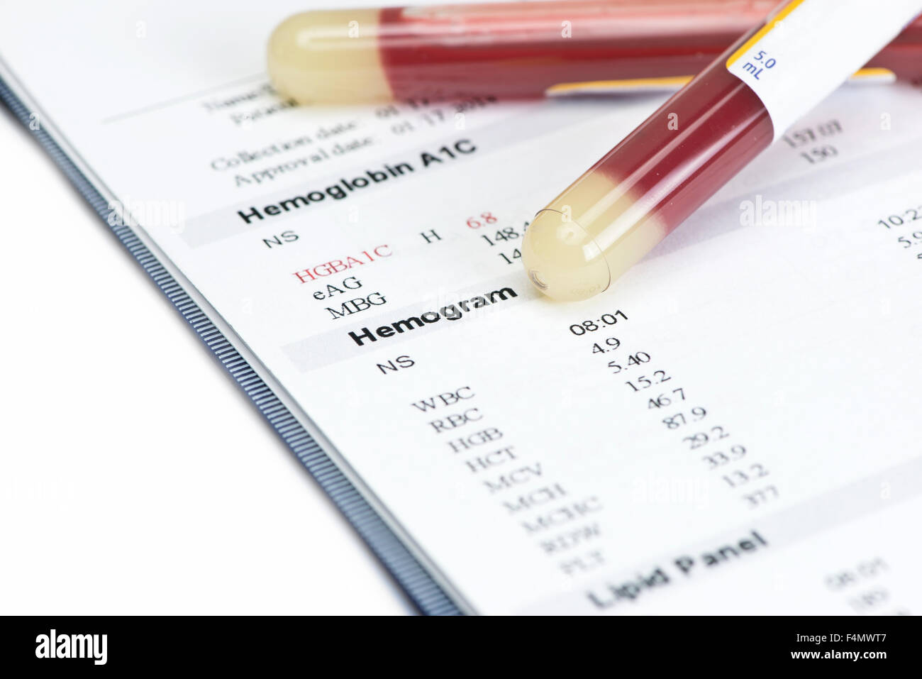 Hematology blood level hemogram report with gold color blood sample ...