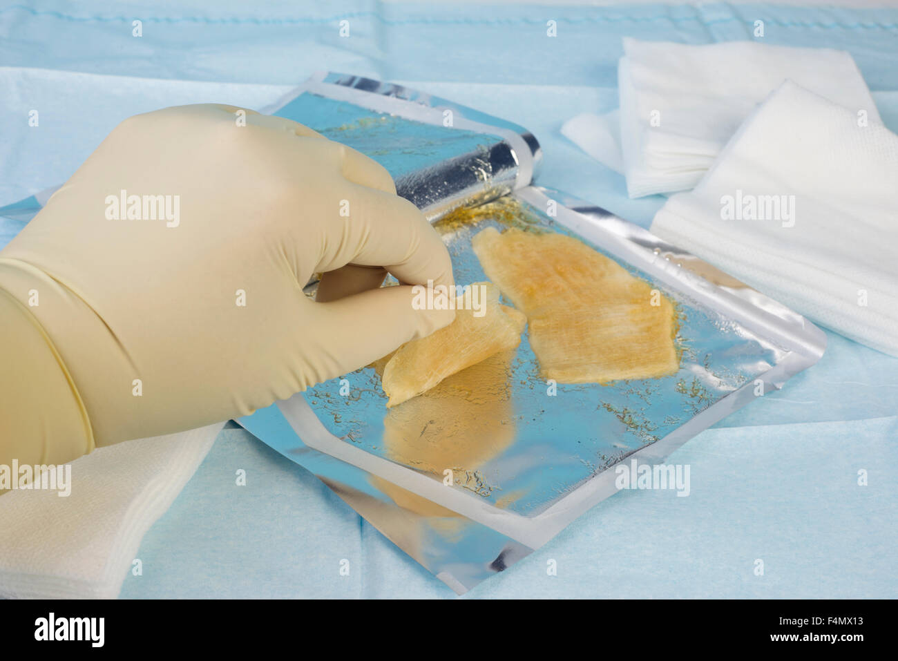 Nurse selects sterile hydrogel dressing for use on a burn or wound ...