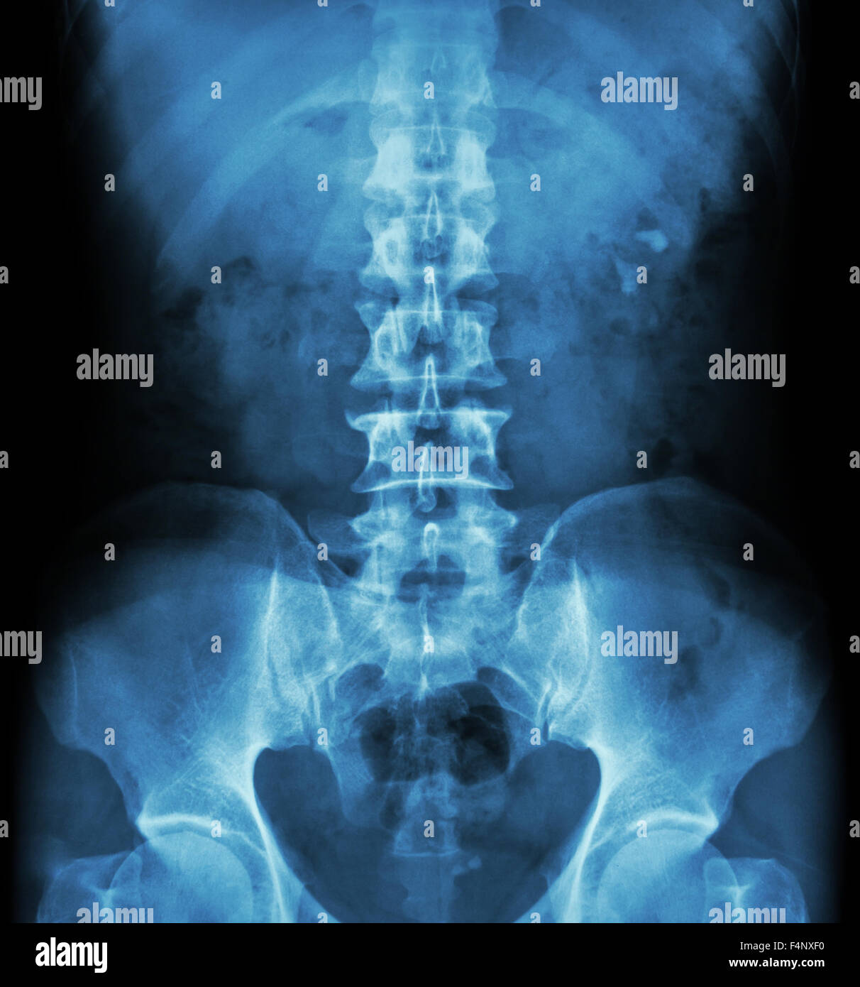 Kidney Stones Kub Xray