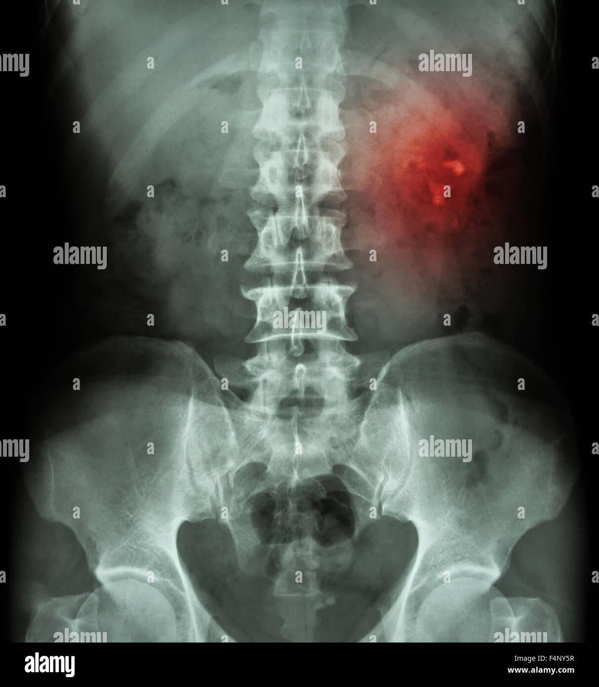 Kidney stone ( renal stone , renal calculi ) ( film x-ray KUB ( Kidney ...