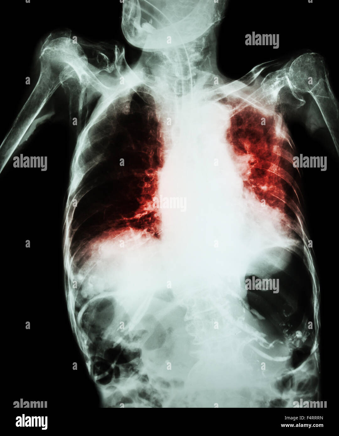 Pulmonary tuberculosis chest x ray interstitial hi-res stock ...