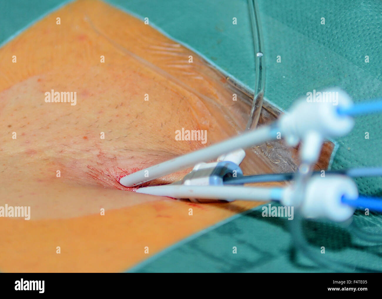 Coronary angiogram hi-res stock photography and images - Alamy