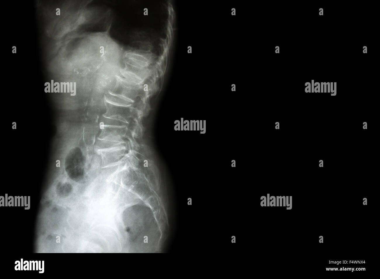 Spondylosis , Spondylolisthesis ( Film x-ray lumbo - sacral spine show ...
