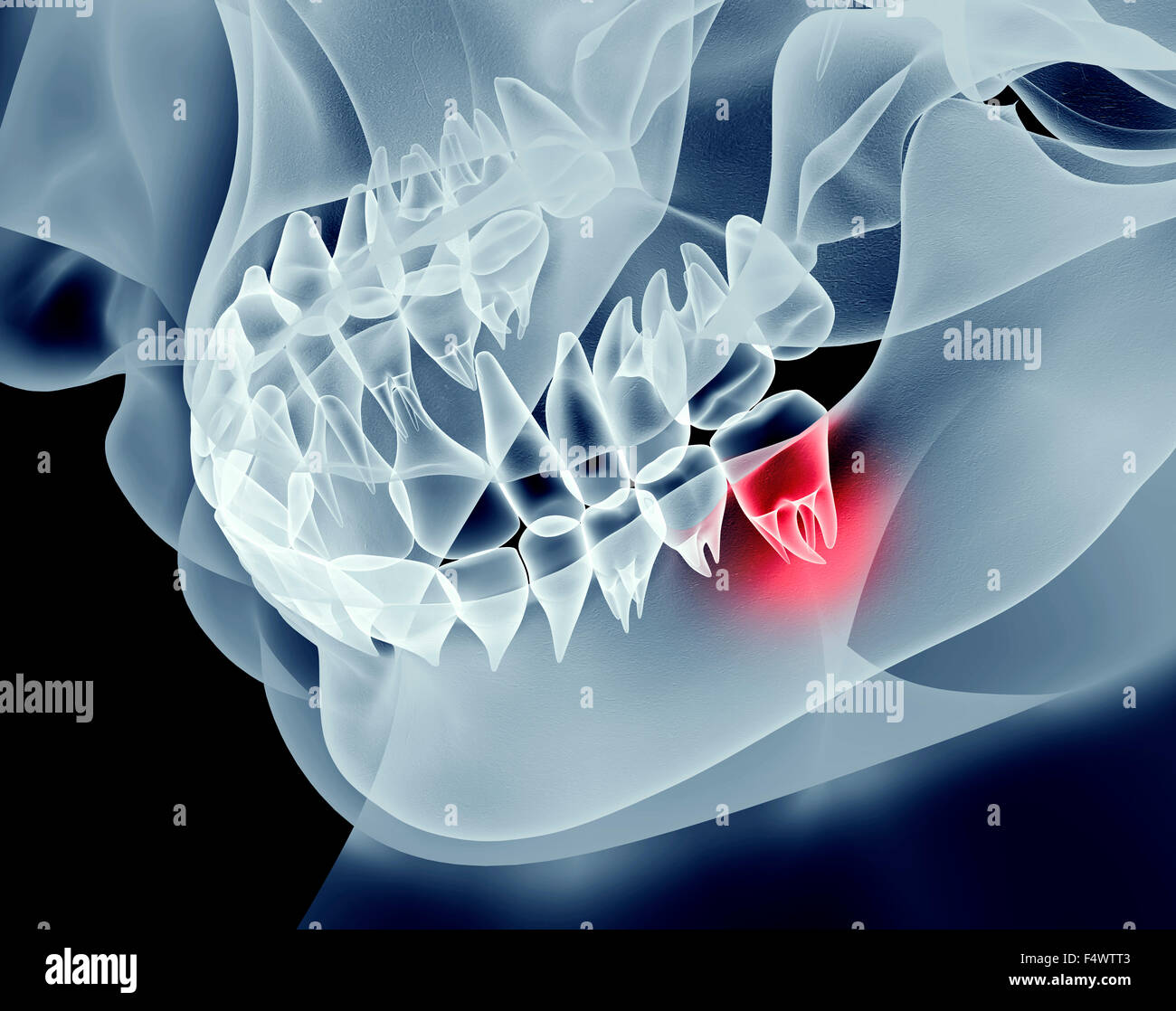 x-ray image of a jaw with teeth with one in pain Stock Photo - Alamy