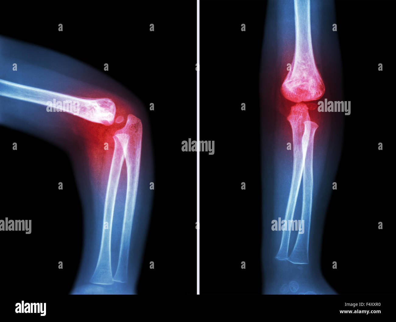 Rheumatoid arthritis , Gouty arthritis ( film x-ray child 's elbow with ...