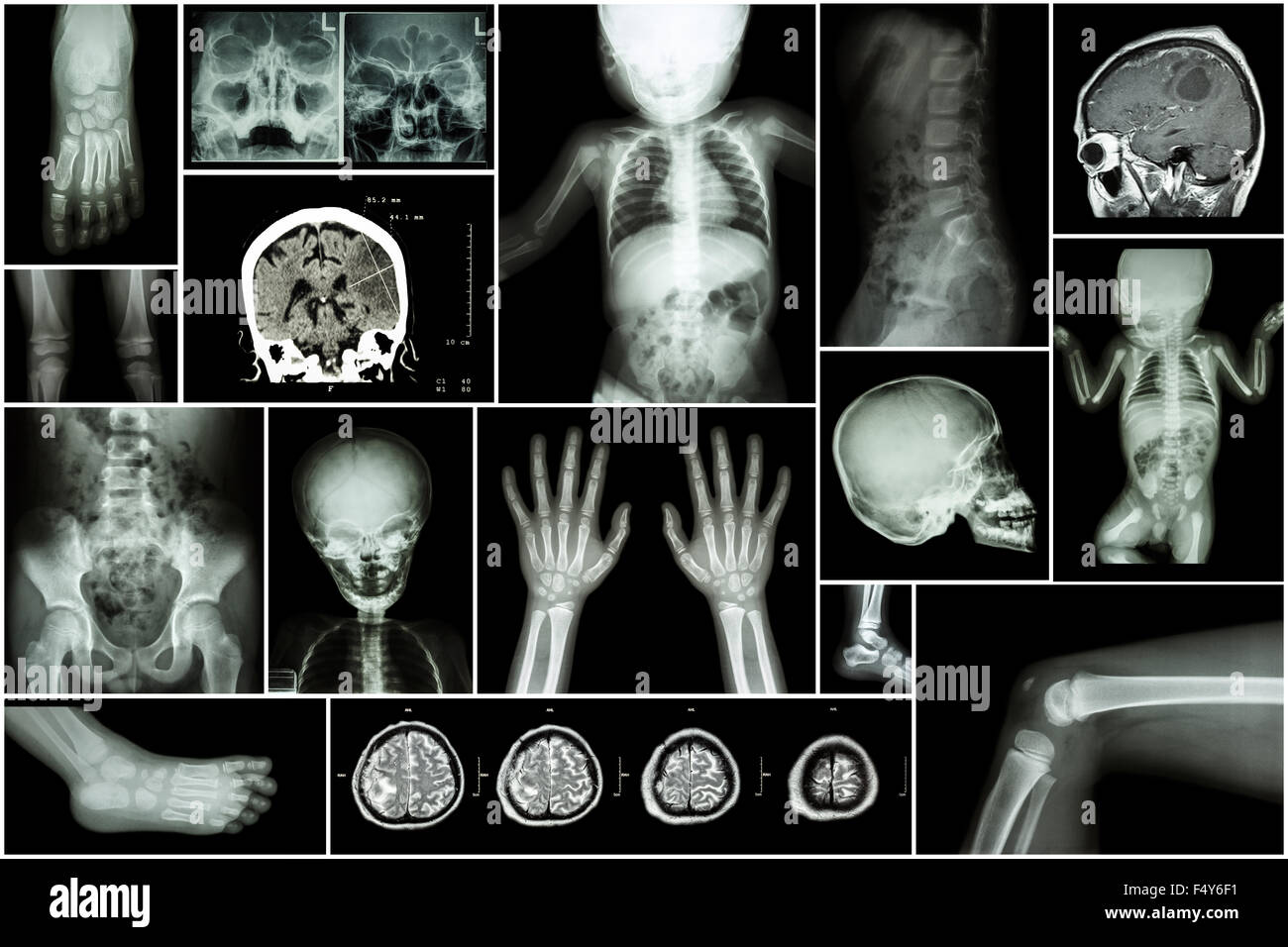 X-ray multiple part of child 's body & multiple disease ( stroke ...