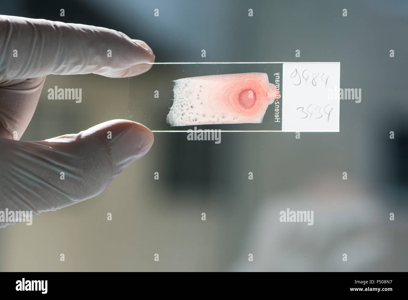 Blood is smeared on a glass slide for diagnosis, held against the light ...