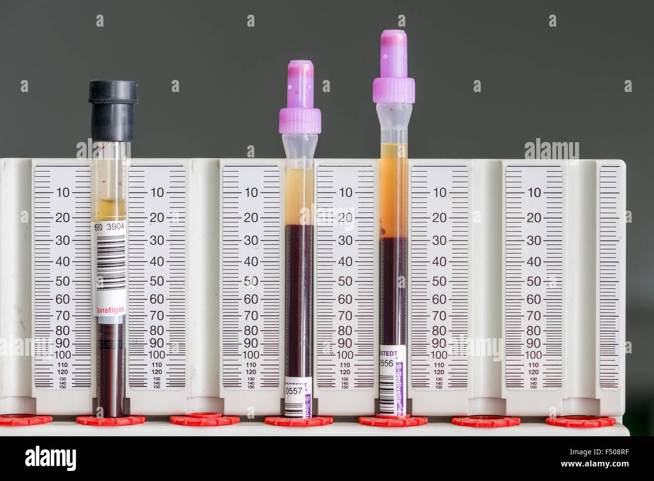 Three monovettes containing a sample for blood sedimentation are placed ...