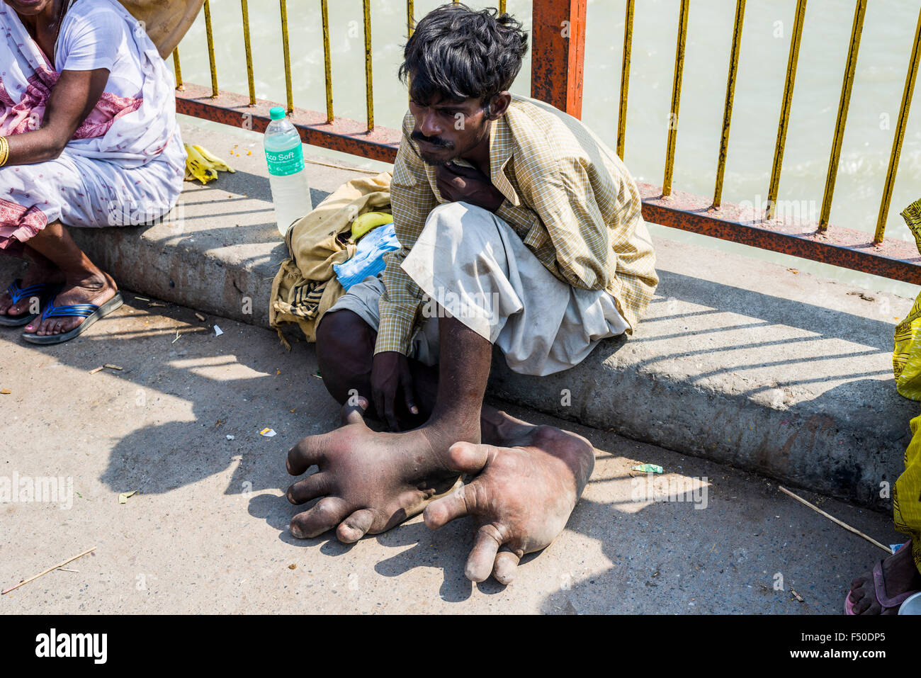 Elephantiasis hi-res stock photography and images - Alamy