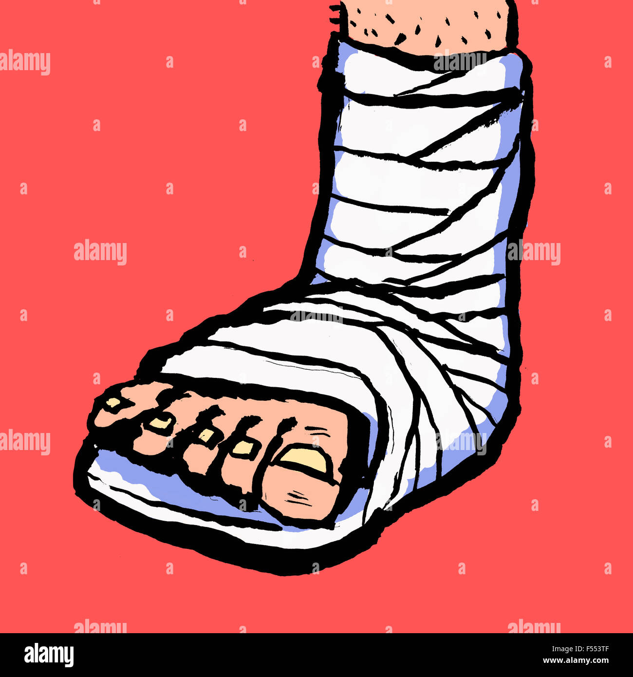 Bandage technique hi-res stock photography and images - Alamy