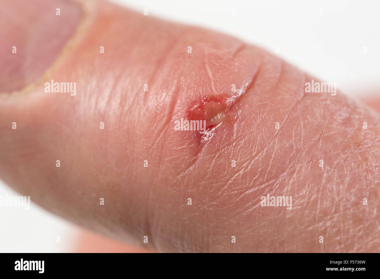 Blood injury scratch hand hi-res stock photography and images - Alamy