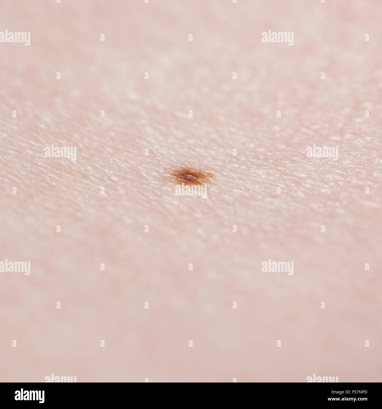 Skin mole hi-res stock photography and images - Alamy