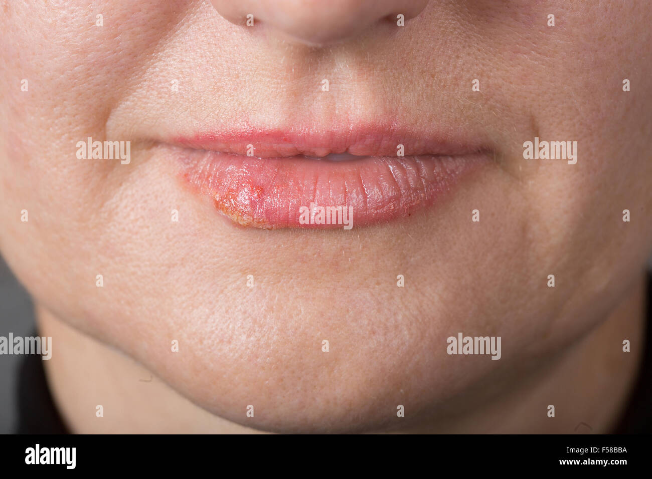 Lip infection with the herpes virus Stock Photo - Alamy