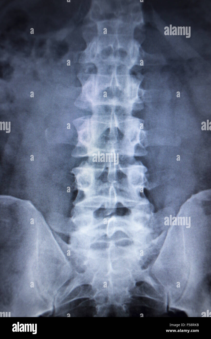 X-ray orthopedic medical CAT scan of painful lower back spine injury in ...