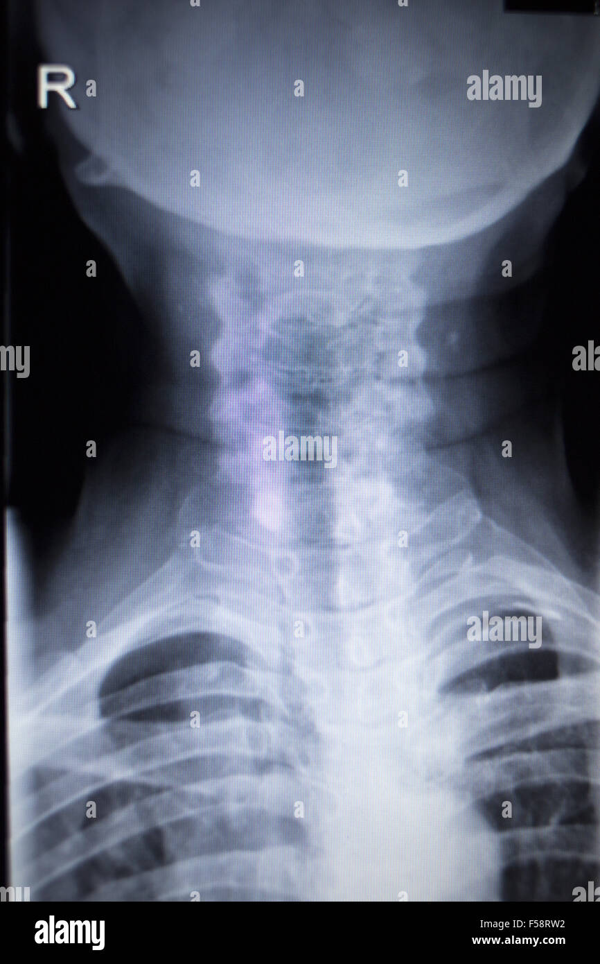 X-ray orthopedic medical CAT scan of painful neck injury in ...
