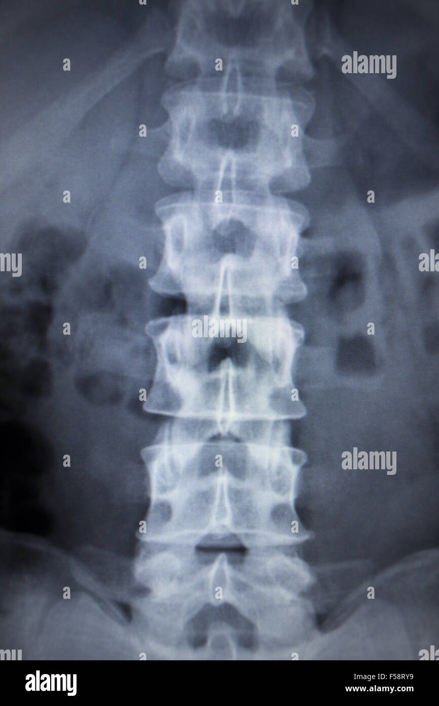 X-ray orthopedic medical CAT scan of painful lower back spine injury in ...