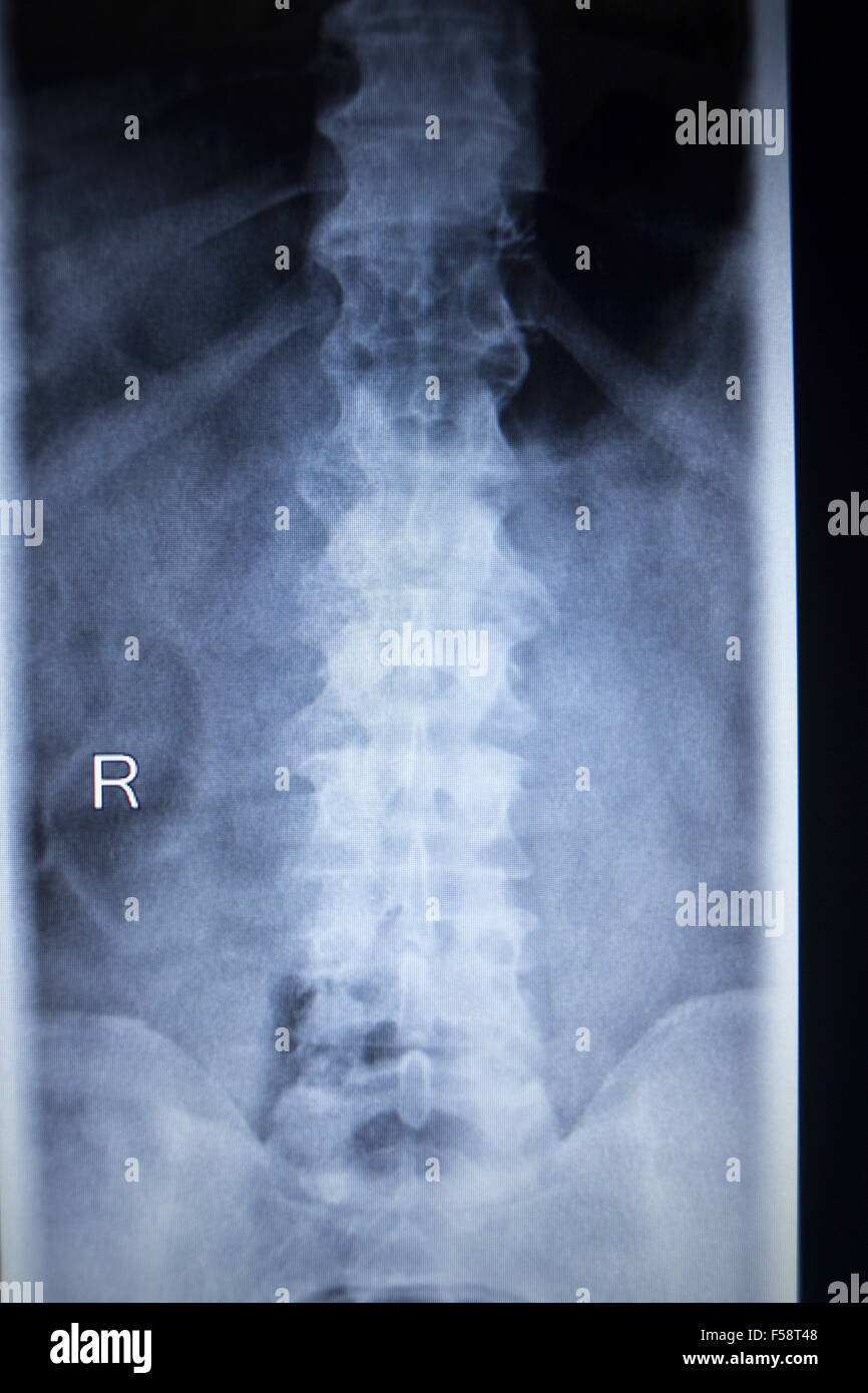 X-ray orthopedic medical CAT scan of painful lower back spine injury in ...