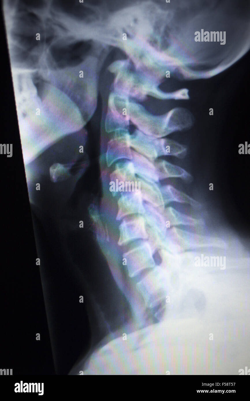 X-ray orthopedic medical CAT scan of painful neck injury in ...