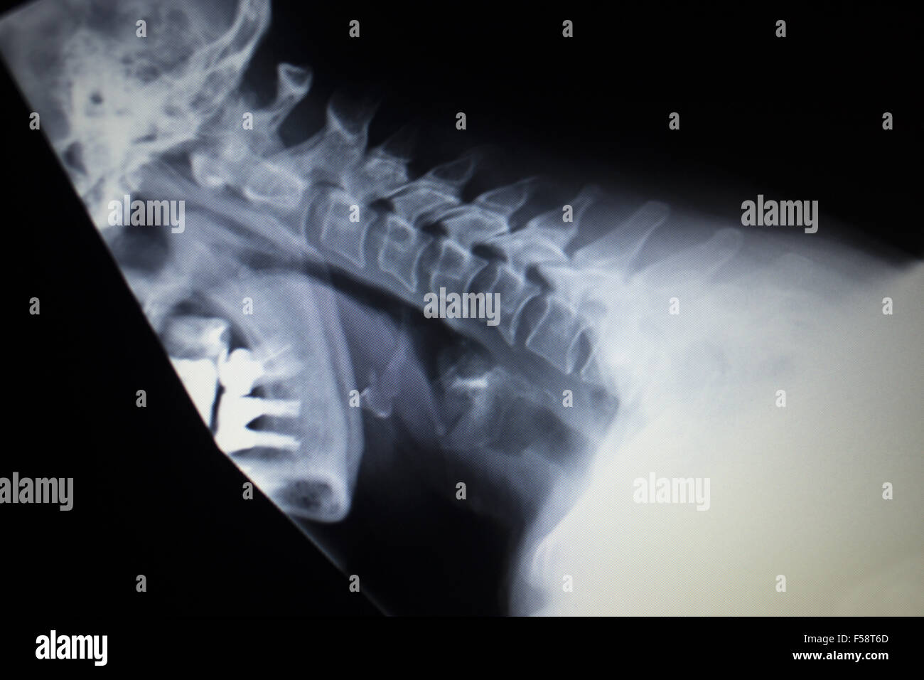 X-ray orthopedic medical CAT scan of painful neck injury in ...