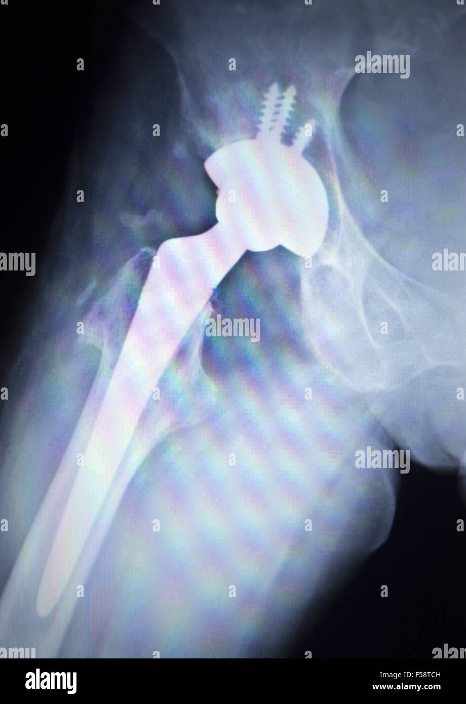 X-ray scan image of hip joints with orthopedic hip joint replacement ...