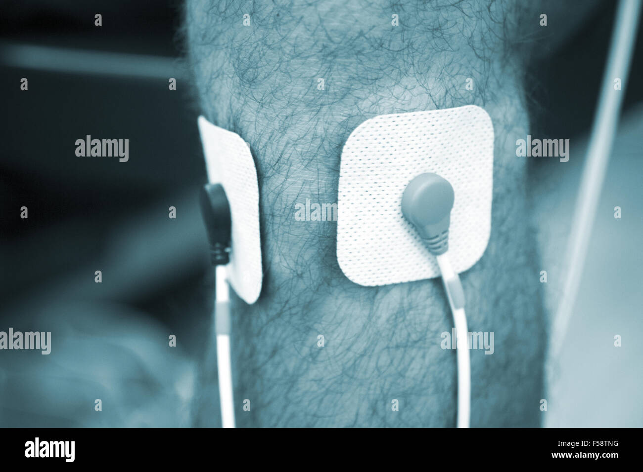 Patient hand arm wrist in electro physiotherapy electrical impulse ...