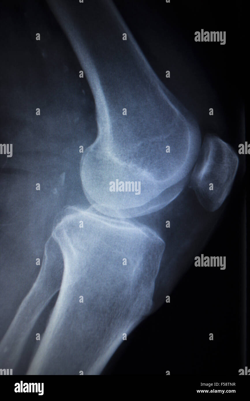 X-ray orthopedic medical CAT scan of painful knee meniscus injury leg ...