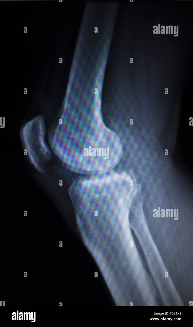 X-ray orthopedic medical CAT scan of painful knee meniscus injury leg ...