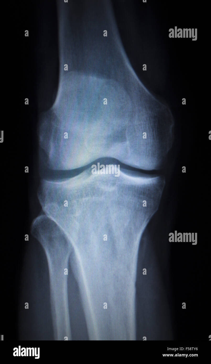 X-ray orthopedic medical CAT scan of painful knee meniscus injury leg ...
