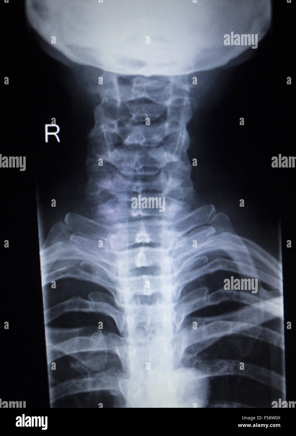 X-ray orthopedic medical CAT scan of painful neck injury in ...