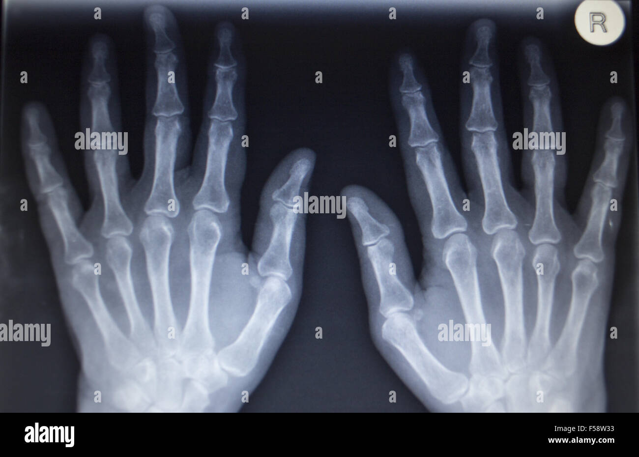 Xray Orthopedic Medical Cat Scan Of Painful Hand Fingers Thumb Stock