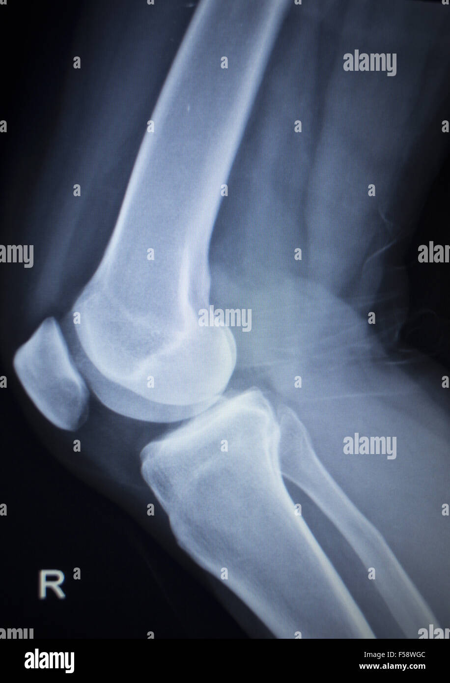 X-ray orthopedic medical CAT scan of painful knee meniscus injury leg ...